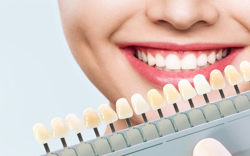 How Dental Veneers Can Correct Various Smile Imperfections - Novel Soul