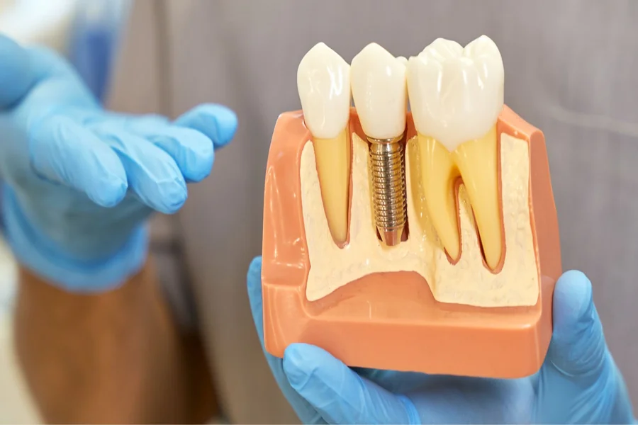 How Bone Density Affects Dental Implant Planning